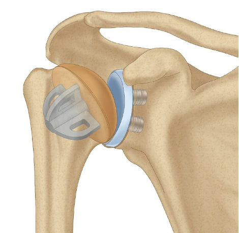 Melbourne Shoulder & Elbow CentreArthroplasty | Melbourne Shoulder ...